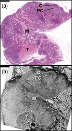 Thorlabs · OCT Identifies Malignancies